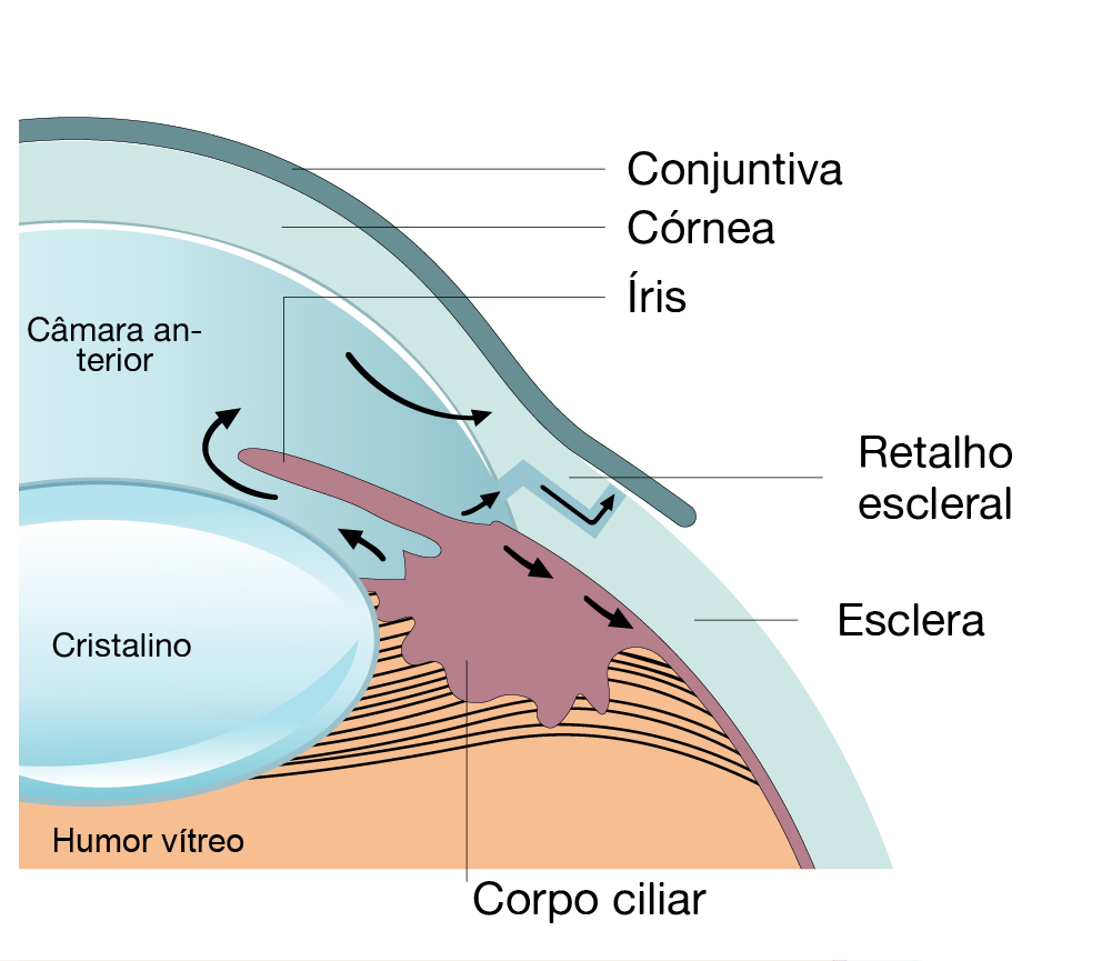 O que é trabeculectomia? Entenda o procedimento! – Central da Visão